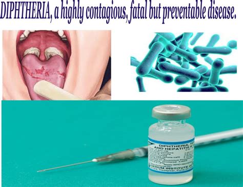 Diphtheria A Highly Contagious Fatal But Preventable Disease