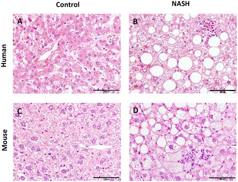 Fatty Liver Histology
