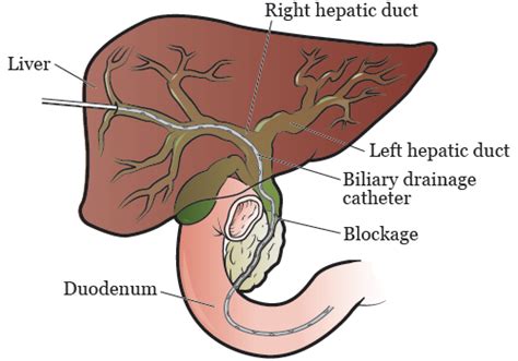 About Your Biliary Drainage Catheter Memorial Sloan Kettering Cancer
