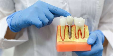 Debridement Dental