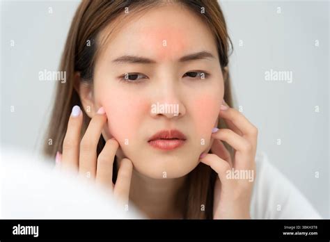 Woman Worried About Face Dermatology Rosacea Dermatitis Allergic Steroids Sensitive Skin Red