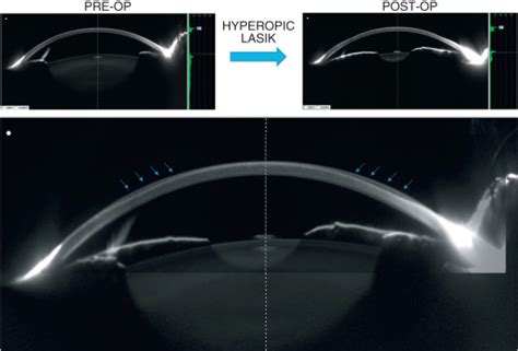 Lasik Q Based And Wavefront Guided Lasik For Myopia Hyperopia And