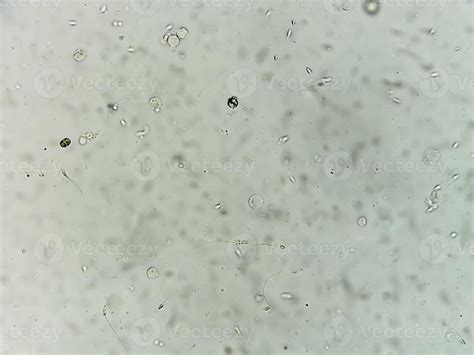 Semen Analysis Under Microscopy Showing Pyospermia Or Leukocytospermia