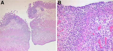 Histopathology Showing Nonspecific Inflammation And Excluding Ibd