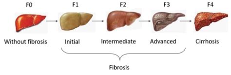 Liverscreen The Progression Process Of Liver Diseases