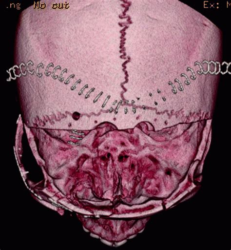 Decompressive Craniectomy For Severe Tbi Neupsy Key