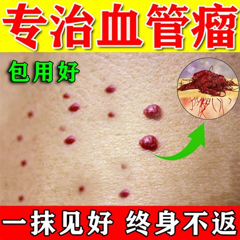 古方箄血管瘤血痣去除专用凝胶婴儿专用红痣红斑痣蜘蛛痣樱桃瘤去除药膏 1盒【血管瘤去除神器】 樱桃状血管瘤血痣去除专用凝胶【图片 价格 品牌