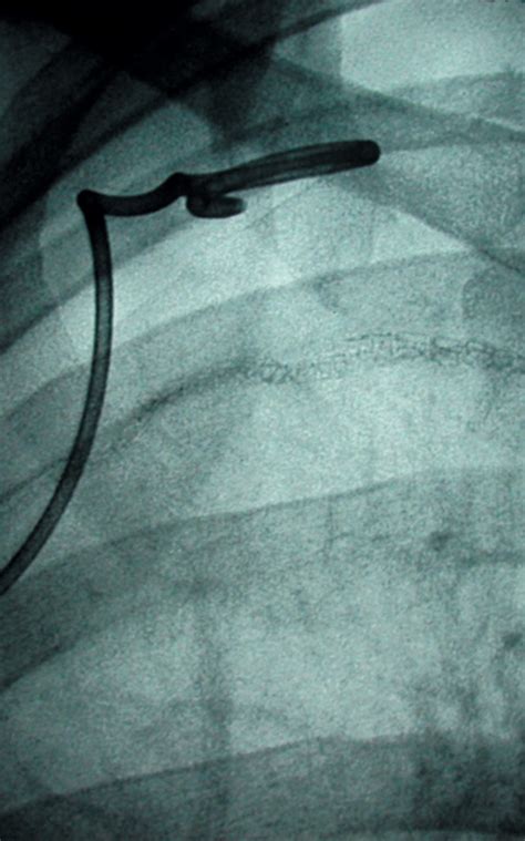 Radiological Review Of Pneumothorax The Bmj