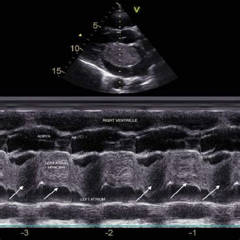 A 1b Showing Intra Mural Thrombus In Right Side Cavities Of Heart