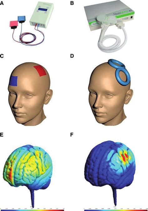 Examples Of Commercial A Transcranial Direct Current Stimulation And