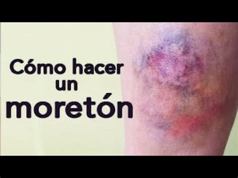 Cómo Hacer Un Moretón Con Paletas De Alcohol Youtube