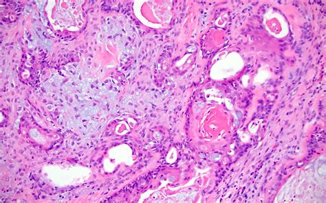Pathology Outlines Pleomorphic Adenoma