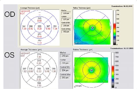 Spectral Domain Optical Coherence Tomography Of Both Eyes Macular Download Scientific Diagram