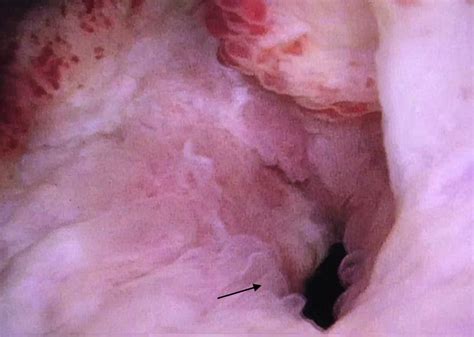 Left Bladder Dome Perforation Demonstrated On Flexible Cystoscopy Download Scientific Diagram