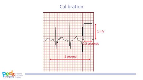 Normal Pediatric Ecg