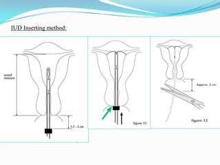 Intra Uterine Devices Pptx