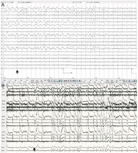 Figure From Automated Seizure Detection Accuracy For Ambulatory EEG Recordings Semantic Scholar