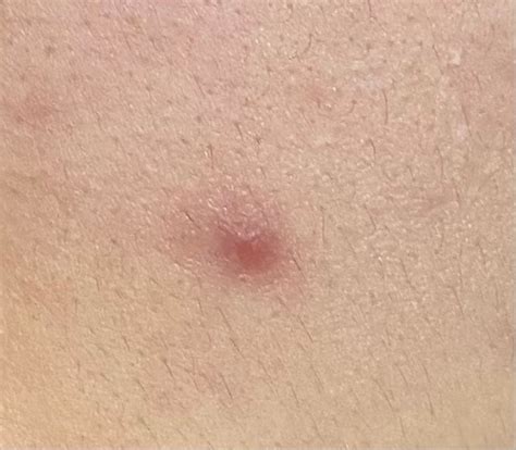 블랙헤드 압출 후 붉은 여드름 지식in