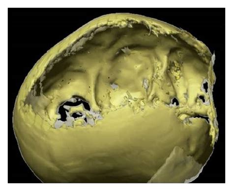 Three Dimensional Reconstructions With Brainlab A Right Lateral Download Scientific Diagram