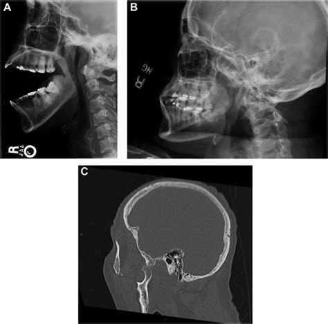 Managing Temporomandibular Joint Dislocations Annals Of Emergency Medicine