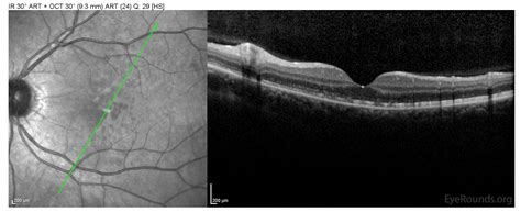 Atlas Entry Acute Macular Neuroretinopathy Amn