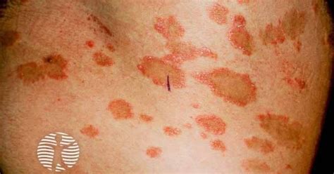 Pityriasis Rosea Image