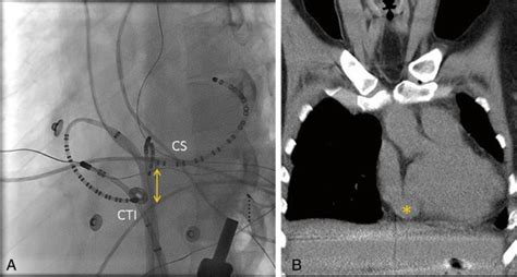 Cardiac Catheterization Interpretation Of Findings Guludeck