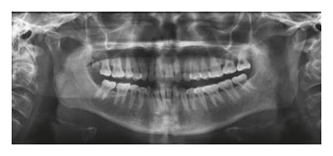 Types Of Dental Imaging A Bitewing X Ray B Periapical X Ray C