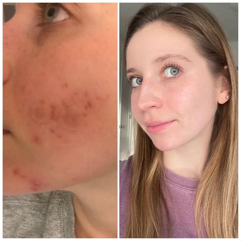 Tretinoin Before And After Scar