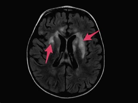T1 A Sequence Hyperintense Lesions In The Periventricular White Matter