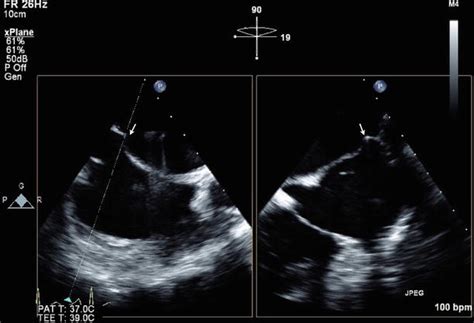 Rheumatic Mitral Valve Disease Acep American College Of Emergency