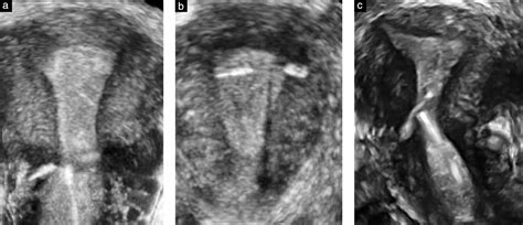 Abnormal Iud Ultrasound