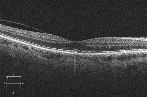 Evolution Of Vmt Oct 1 Retina Image Bank
