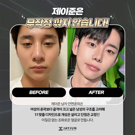 제이준성형외과 여자와는 다른 남자의 윤곽 무작정 깎지 않는 제이준 남자윤곽은 남성미와 세련된