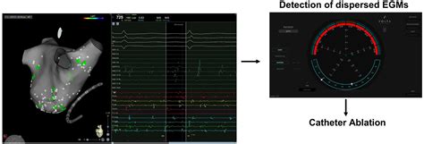Dispersion Electrogram Detection With An Artificial Intelligence Software In Redo Paroxysmal