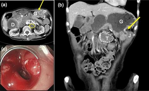 Laparoscopic Duodenojejunostomy Requiring A Side To Side Jejunojejunostomy In Malignant Stenosis