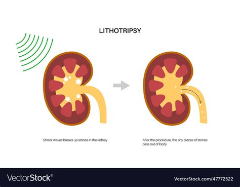 Lithotripsy Procedure Concept Royalty Free Vector Image