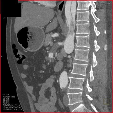Superior Mesenteric Artery Sma Dissection And Occlusion Lnkd