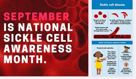 How Sickle Cell Anemia Affects A Persons Life Eman Elzain Posted On