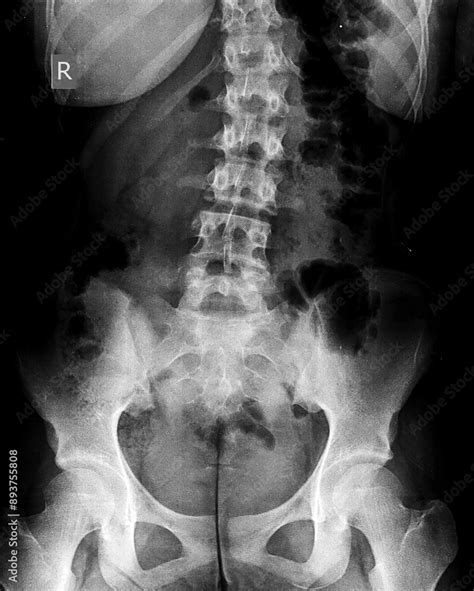 X Ray Of Idiopathic Scoliosis Of Lumbar Spine Part Of Adolescent