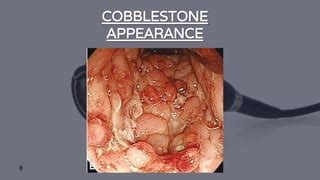 Investigations Crohns Disease Pptx