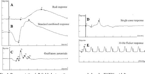 Figure 1 From Electroretinogram In Hereditary Retinal Disorders Semantic Scholar