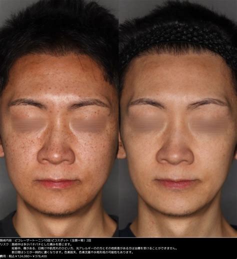 ピコスポットとは？効果やダウンタイムについて徹底解説│select Clinic Tips