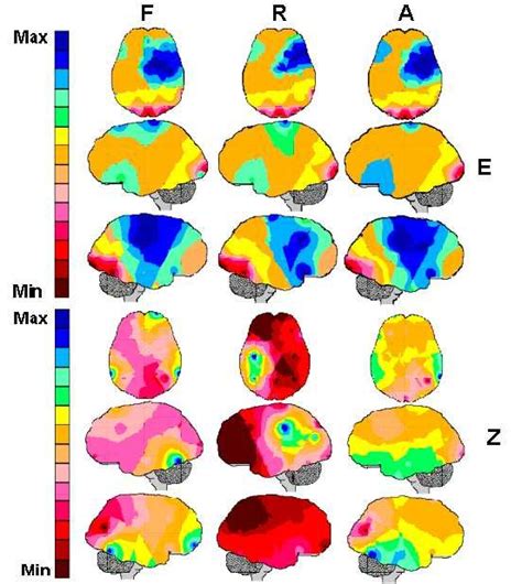 Mean Entropy Brain Mapping E Associated With Facial Self Evaluation