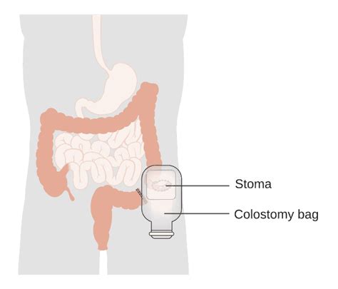 Colostomy Wikiwand
