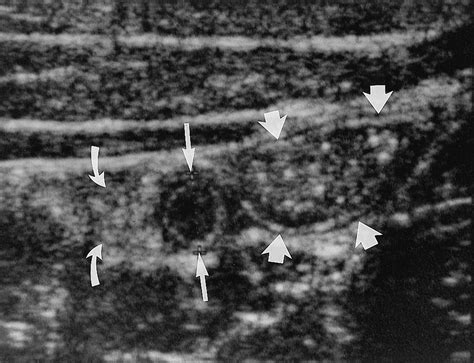 Outer Diameter Of The Vermiform Appendix As A Sign Of Acute Appendicitis Evaluation At Usradiology