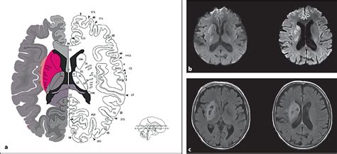 Lenticulostriate Arteries Stroke