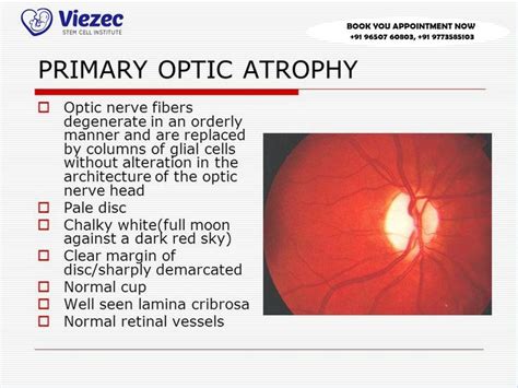 Primary Optic Atrophy Stem Cell Therapy Stem Cells Nerve Fiber