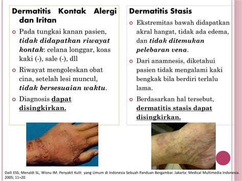 Ppt Presentasi Kasus Dermatitis Numularis Powerpoint Presentation Free Download Id3673313