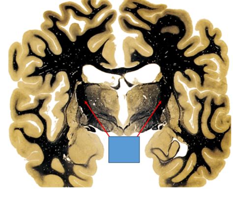 Neuro 3050 Exam 2 Descending Pathways Lecture 6 Flashcards Quizlet
